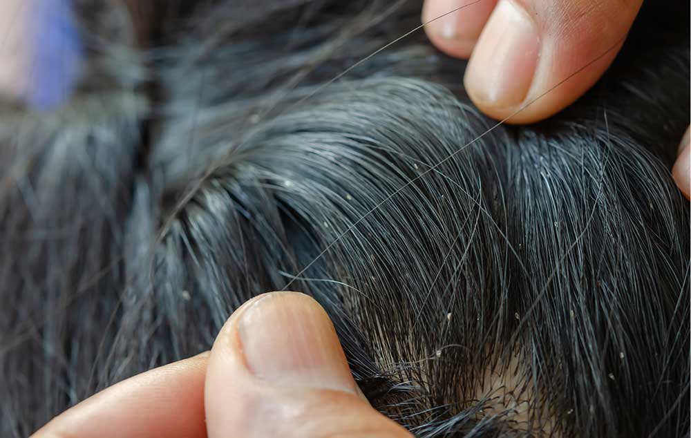 mosquito® Läuse-Kamm | mosquito-laeuse